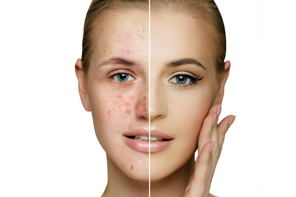 The BCP Acne Treatment Regimen - Formulae-Maroochydore